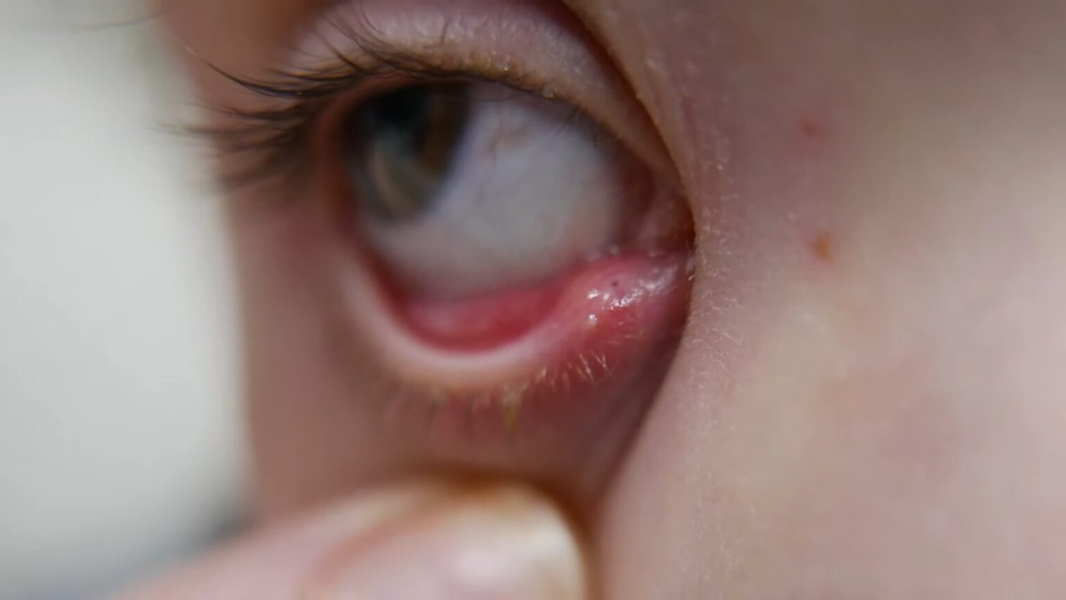 Dacryoadenitis: Symptoms, Causes, Diagnosis, and Management