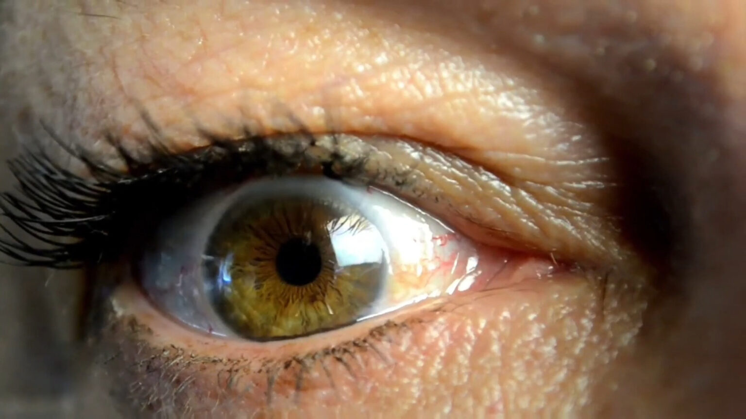 Dacryoadenitis: Symptoms, Causes, Diagnosis, and Management
