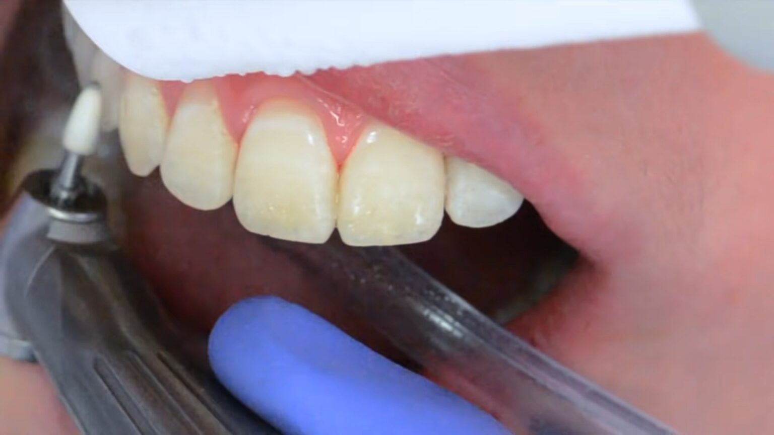 Fluorosis: Causes, Diagnosis, Management, and Prevention