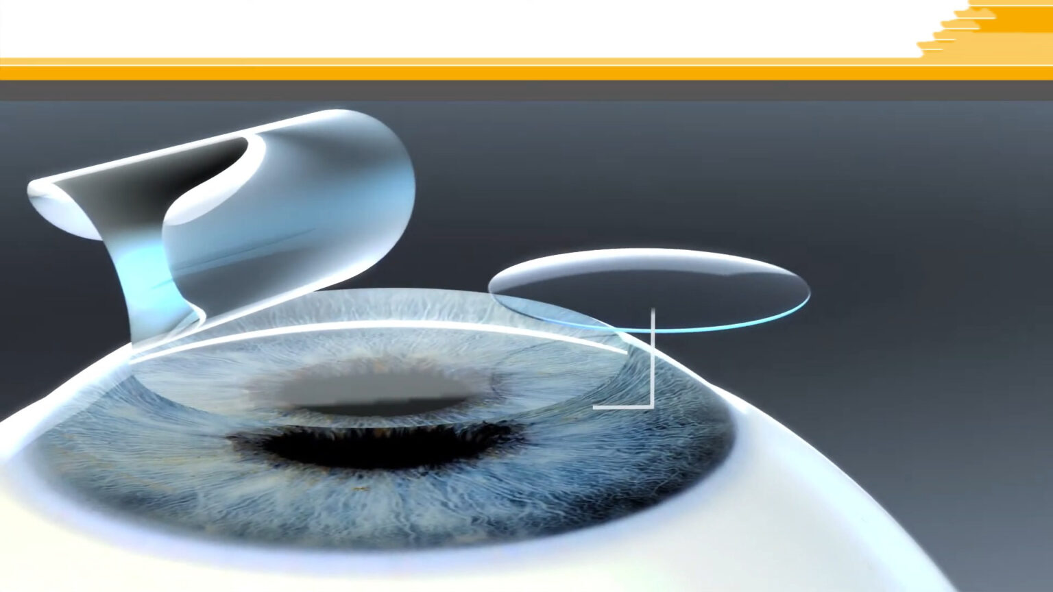 Hypermetropia: Symptoms, Causes, Diagnosis, Management, and Complications