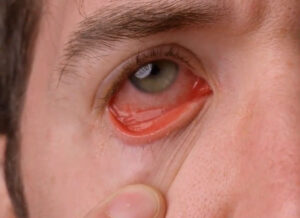 Epidemic Keratoconjunctivitis (EKC) Diagnosis and Management